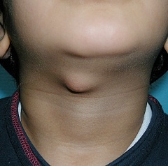 A nyak oldalán ciszta tüneteket okoz