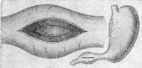 Стеноза на пилора при деца, лекувани