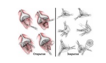 Хемороидектомия по оперативна техника на Milligan Morgan ...