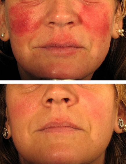 Rozacee (rozacee) - cauze si simptome, tratamente