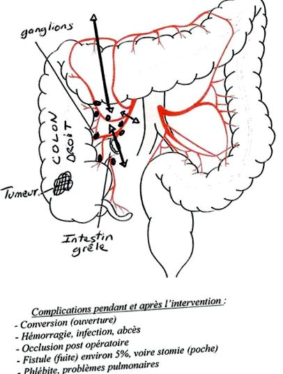 Vastagbél műtét vagy colectomia a Lyon Center Lyonnais de Chirurgie ...
