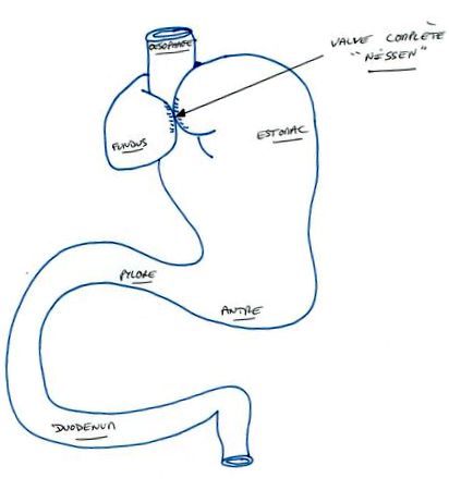 Fundoplicatură - reflux gastro-esofagian - Chirurgie Viscerală și ...