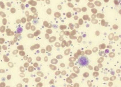 Simptomele, cauzele și tratamentul trombocitozei - pas către sănătate