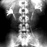 Nephroptosis - okai, tünetei, diagnózisa és kezelése