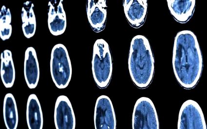 Mŕtvica (apoplexia) - príznaky, príčiny, liečba Dr.