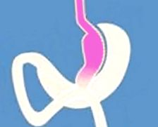 Bypass gastric buclă Omega ("mini bypass") chirurgie bariatrică ...