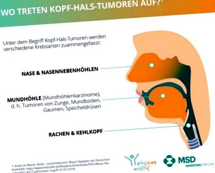 Imuno-onkológia - rakovina hlavy a krku