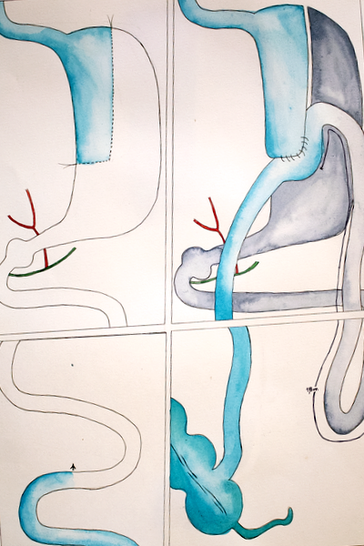 Omega-Loop-Bypass - практика д-р