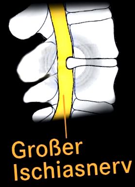 Az isiász tünetei, kezelése és terápiája szakrendelésen