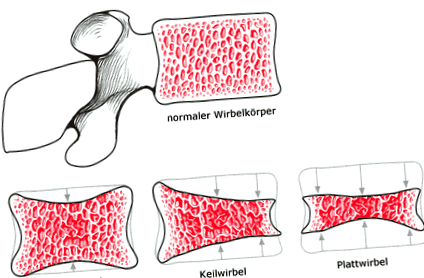 Osteoporosis - csigolya összeomlás