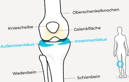 Zranenia menisku - príčiny, príznaky a cvičenia Vivira