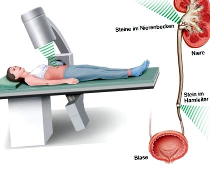 Liečba kameňov v obličkách a močovode - obličkové kamene a kamene v ...