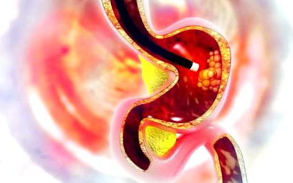 Rakovina žalúdka - príznaky, príčiny, terapia, rehabilitácia