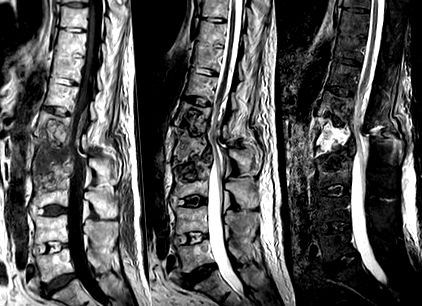 Bechterew-kór - minden a spondylitis ankylopoetikájáról