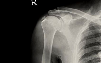 Болка в рамото 11 причини, 4 симптома и 5 лечения Пълно познание, болка ...