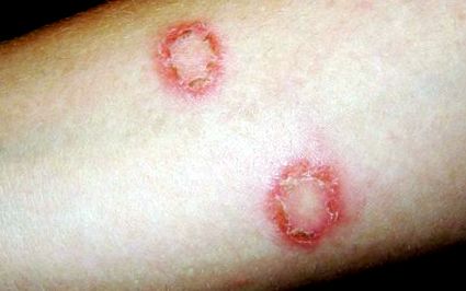 Giardia sintomas en la piel