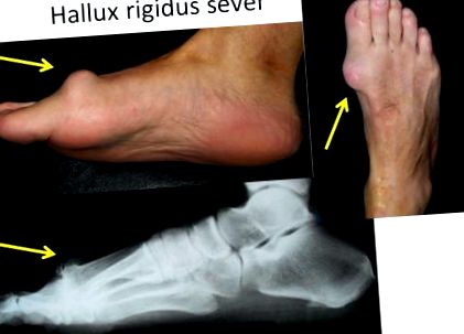 Hallux rigidus - Osteoarthritis