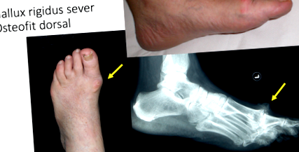 Hallux rigidus - Osteoarthritis