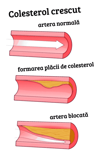A koleszterin fokozódása, jelek, hatékony megelőzés