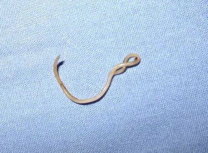 Gliste u stolici kod macaka - Хирургия на рак на щитовидната жлеза