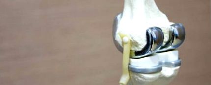 Metódy výskumu chorôb kolena - Gonartróza - Vojenská pohotovostná ...