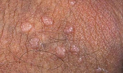 Генітальні бородавки та прижигання, Condyloma acuminata у немовляти