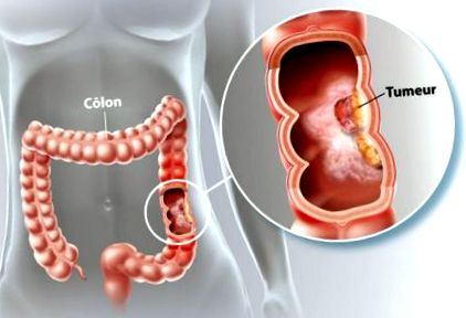 Rakovina hrubého čreva - všeobecné