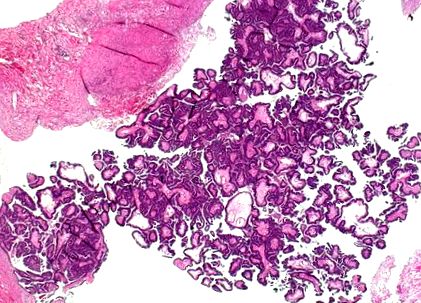Apokrin cystadenoma tumor Ductalis papilloma carcinoma