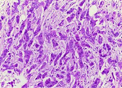 Apokrin cystadenoma tumor Ductalis papilloma carcinoma