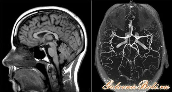 RMN cerebral (imagini prin rezonanță magnetică)