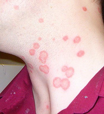 Pecingine cauze, simptome, tratament, prevenire