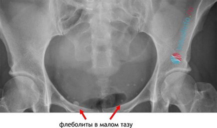 Flebolity în pelvis și picioare cauze, tratament, simptome