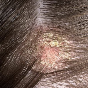 Apariția dermatita seboreica pe cap la copii cum să recunoască și cum ...